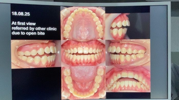 굿스마일치과 | treatment of skeletal class I, dental open bite 1… | 굿스마일치과교정과치과의원
