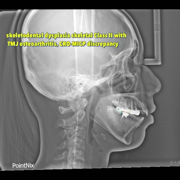 굿스마일치과 | Treatment of a patient with severe TMJ resorption,… | 굿스마일치과 ...